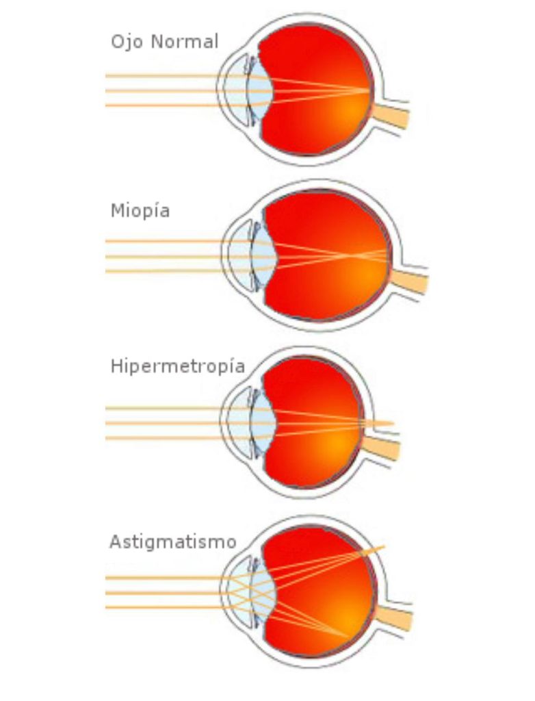 Miopía, Hipermetropía y Astigmatismo - Linus Oftalmólogo